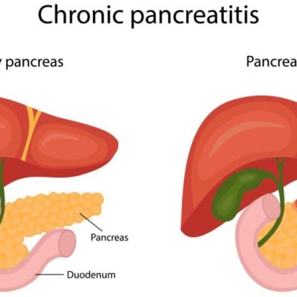 Chronic Pancreatitis Slide Show Understanding Chronic Pancreatitis